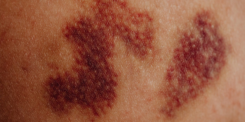 The Most Common Early Signs of Melanoma